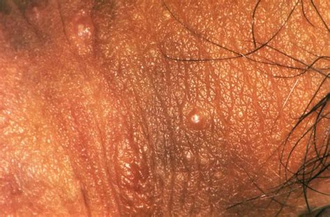 Molluscum Contagiosum Penis Telegraph