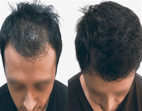 Injerto Capilar Antes Y Despu S Resultados Capilclinic Colombia