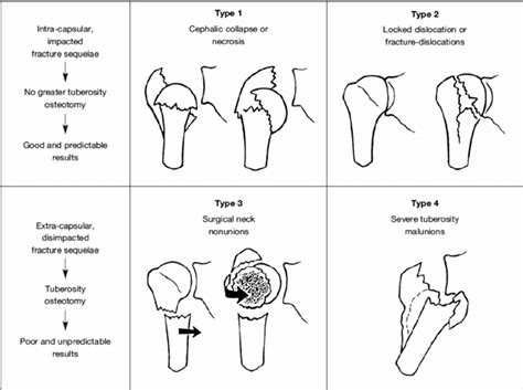 Proximal Humerus Fracture Sequelae According To Boileau Et Al 1
