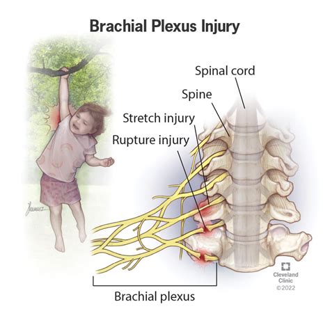 Brachial Plexus Injury What It Is Symptoms Treatment 44 OFF