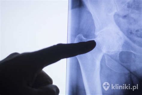 Alloplastyka całkowita cementowa stawu biodrowego kiedy stosuje się