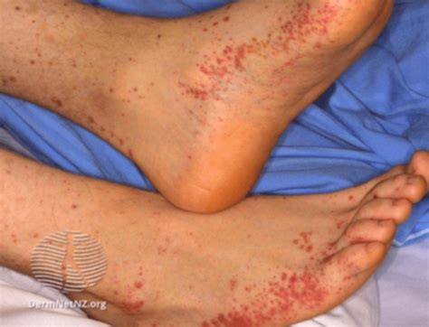 Infection Quiz Entire Module Flashcards Quizlet