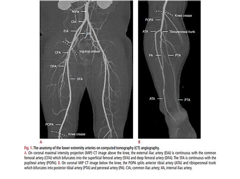 Lower Extremity Arterial Ultrasound Radiology