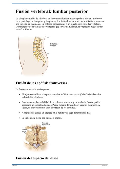 Text Fusión vertebral lumbar posterior HealthClips Online