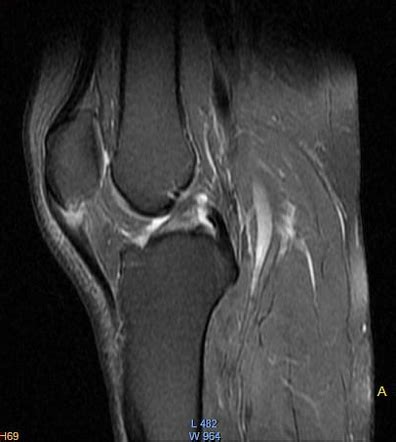 Patellar Tendinitis Jumper S Knee Radiology Case Radiopaedia Org