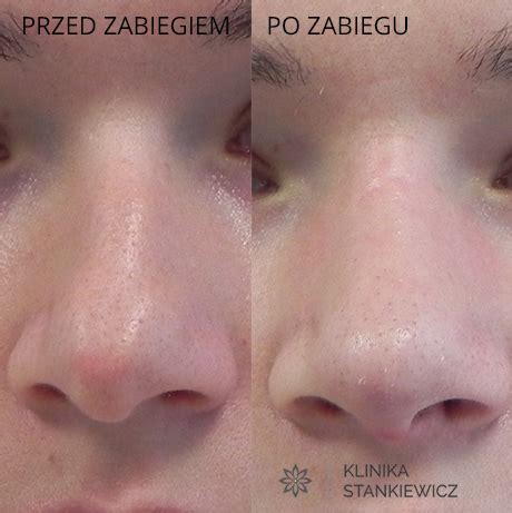 Operacja plastyczna nosa Elbląg Plastyka nosa Korekta nosa Klinika