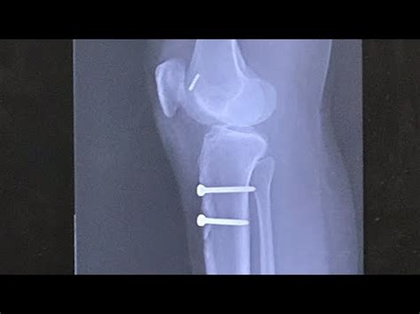 What To Expect When You Are Expecting MPFL Reconstruction Surgery