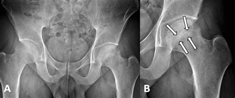 Bilateral Avascular Necrosis Of The Femoral Heads Secondary To Familial