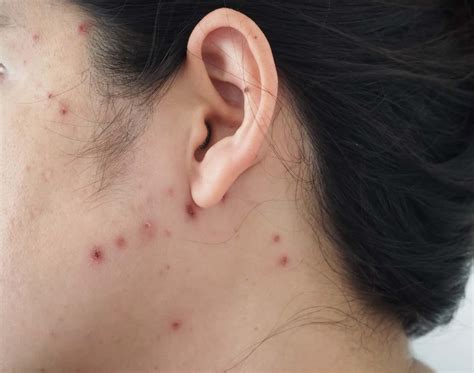 Gejala Cacar Air Yang Muncul Pada Setiap Fase Penyakit