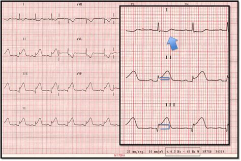 Traçado De Ecg Infarto RETOEDU