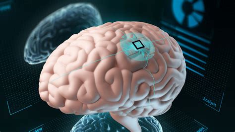 Va t on désormais soigner la dépression grâce à des implants La