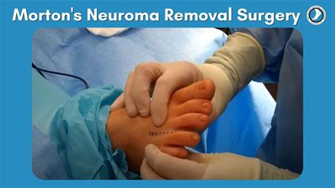 Morton S Neuroma Removal Surgery Youtube