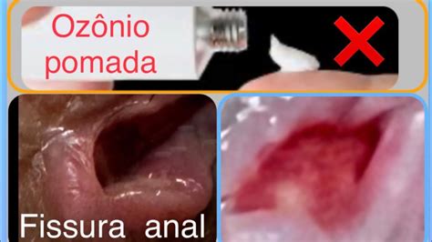 Pomada OZONIO p fissura anal Não indico p não atua sua causa que é