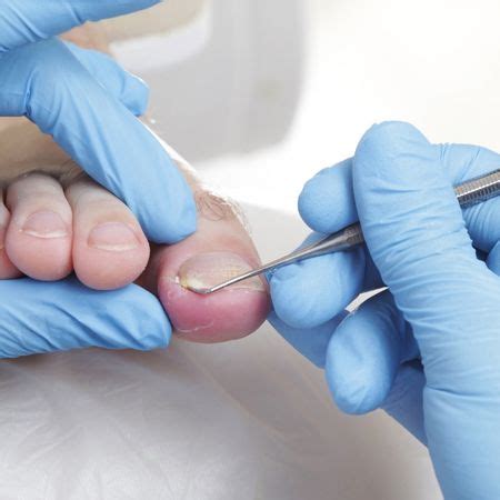 Can My Gp Fix My Ingrown Toenail Advance Foot Clinic Podiatry