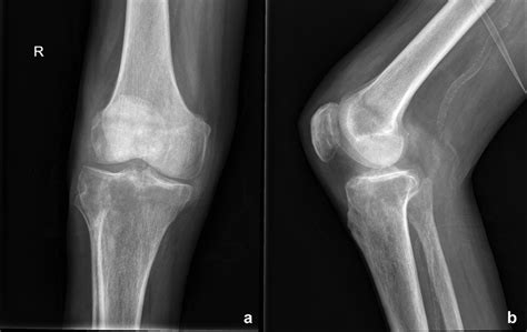 Radiography Acquired In Antero Posterior A And Latero Lateral B