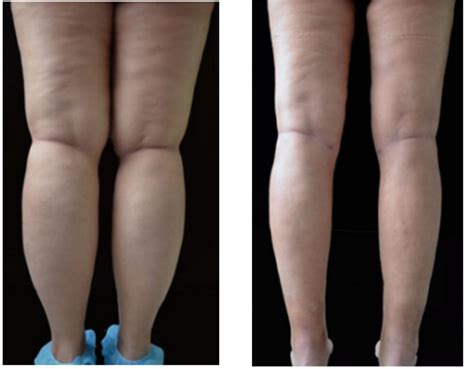 Lipoaspiração HD revelando o que é e como realizar Bellezie