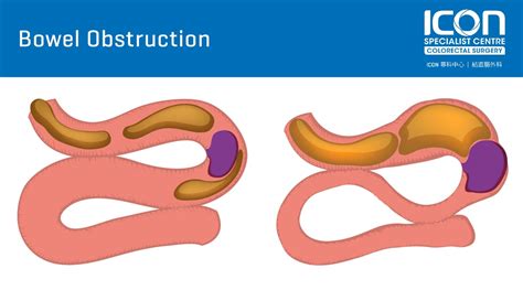Bowel Obstruction Icon Specialist Centre