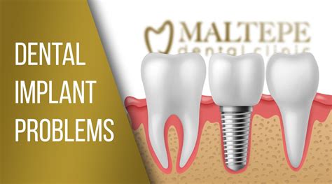 Dental Implant Problems Maltepe Dental Clinic