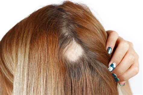 Cómo es la alopecia en mujeres Blog capilar