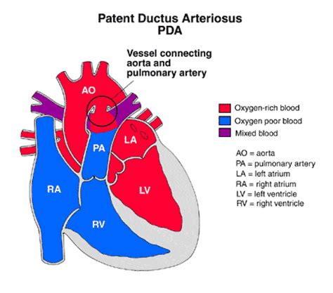 Patent Ductus Arteriosus PDA Focus Dentistry