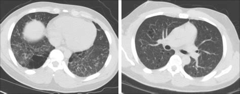 Pulmonary Langerhans Cell Histiocytosis With Systemic Features The