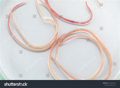 Ascariasis Disease Caused By Parasitic Roundworm Stock Photo 1224545194