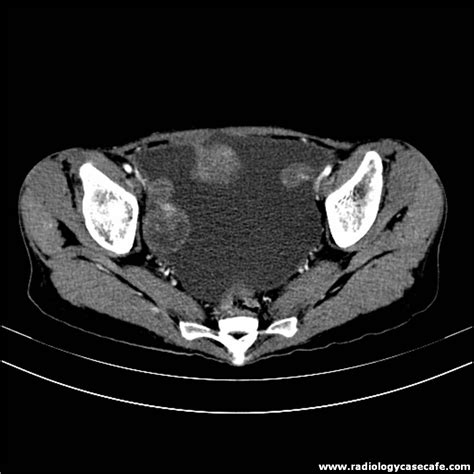 Abdomen Radiology Case Cafe