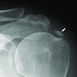 Calcific Tendinitis In 45 Year Old Woman With Left Shoulder Pain
