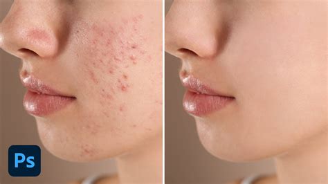 How To Easily Remove Acne Blemishes In Photoshop Youtube