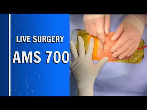 Inflatable Penile Prosthesis Live Surgery AMS 700 LGX 3 Pc Implant
