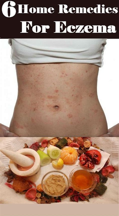 6 Home Remedies For Eczema Home Remedies For Eczema Eczema Remedies Home Remedies