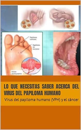 LO QUE NECESITAS SABER ACERCA DEL VIRUS DEL PAPILOMA HUMANO Virus Del