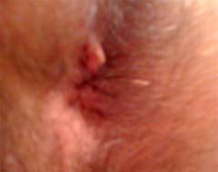 Plicoma Anal COLONOSCOPIA COLOPROCTOLOGIA ENDOSCOPIA