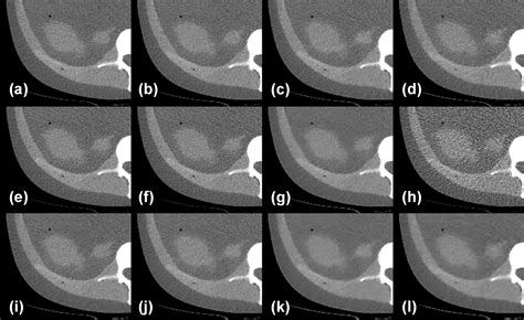 characterization of a computed tomography iterative reconstruction algorithm by image quality