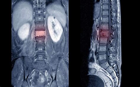 Vertebral Tumor Hart Garner MD Minnesota Spinal Neurosurgeon