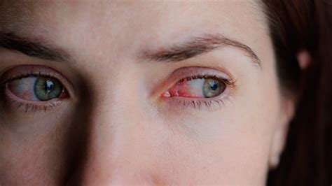 Qué es la conjuntivitis Tipos Síntomas y Tratamiento