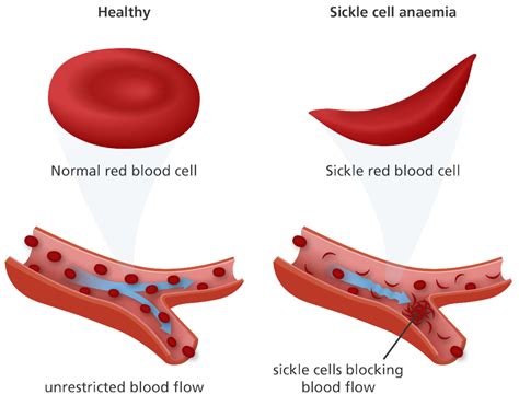 Sickle Cell Disease Causes Fenetics Symptoms Diagnosis 47 OFF