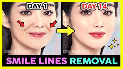 Latest SMILE LINES LAUGH LINES REMOVAL AND FILL WITH KOREAN FACE