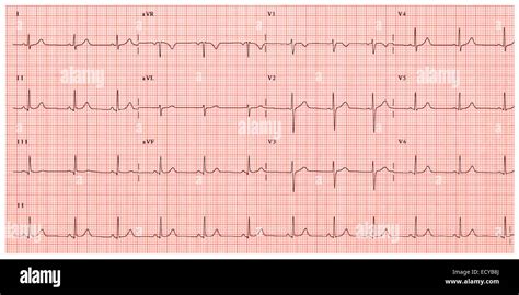 Electrocardiogramas Ejemplos