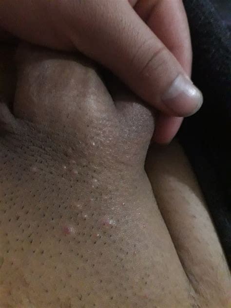 Granos En El Pene Resuelto