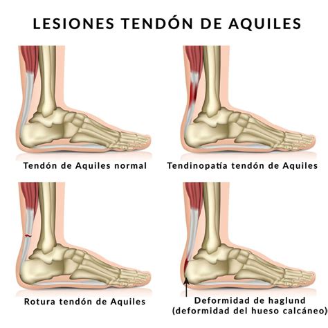 Tendinopatía del tendón de aquiles qué es y cómo tratarla