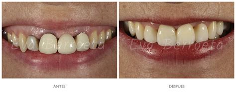 Coronas de porcelana Clínica Dental Clinica Eva Berroeta