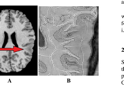 computation of the gradient vector flow gvf in a patient with fcd download scientific