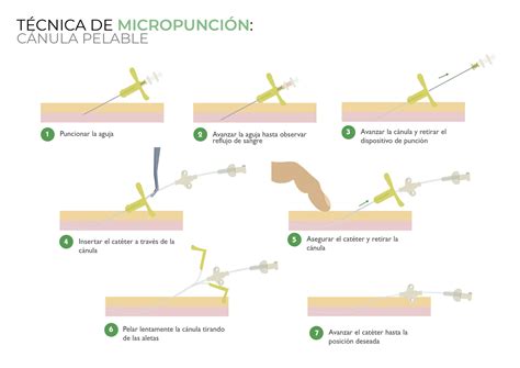Canalización PICC neonatal con Técnica microseldinger cánula pelable