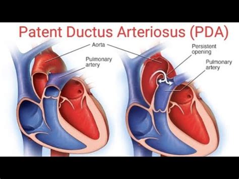 Patent Ductus Arteriosus PDA Pathophysiology Clinical