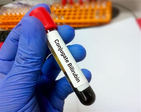 Científico sostenga una muestra de sangre para la prueba de bilirrubina