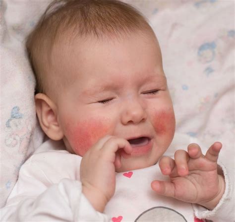 Eczema cauze simptome tratament prevenţie