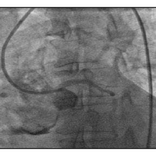 A Acute Aortic Dissection At The Time Of Dye Injection With The Guide