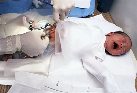 Circumcision Procedure Pros Cons Benefits Okkii