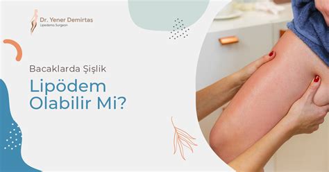 Bacaklarda Şişlik Lipödem Olabilir Mi
